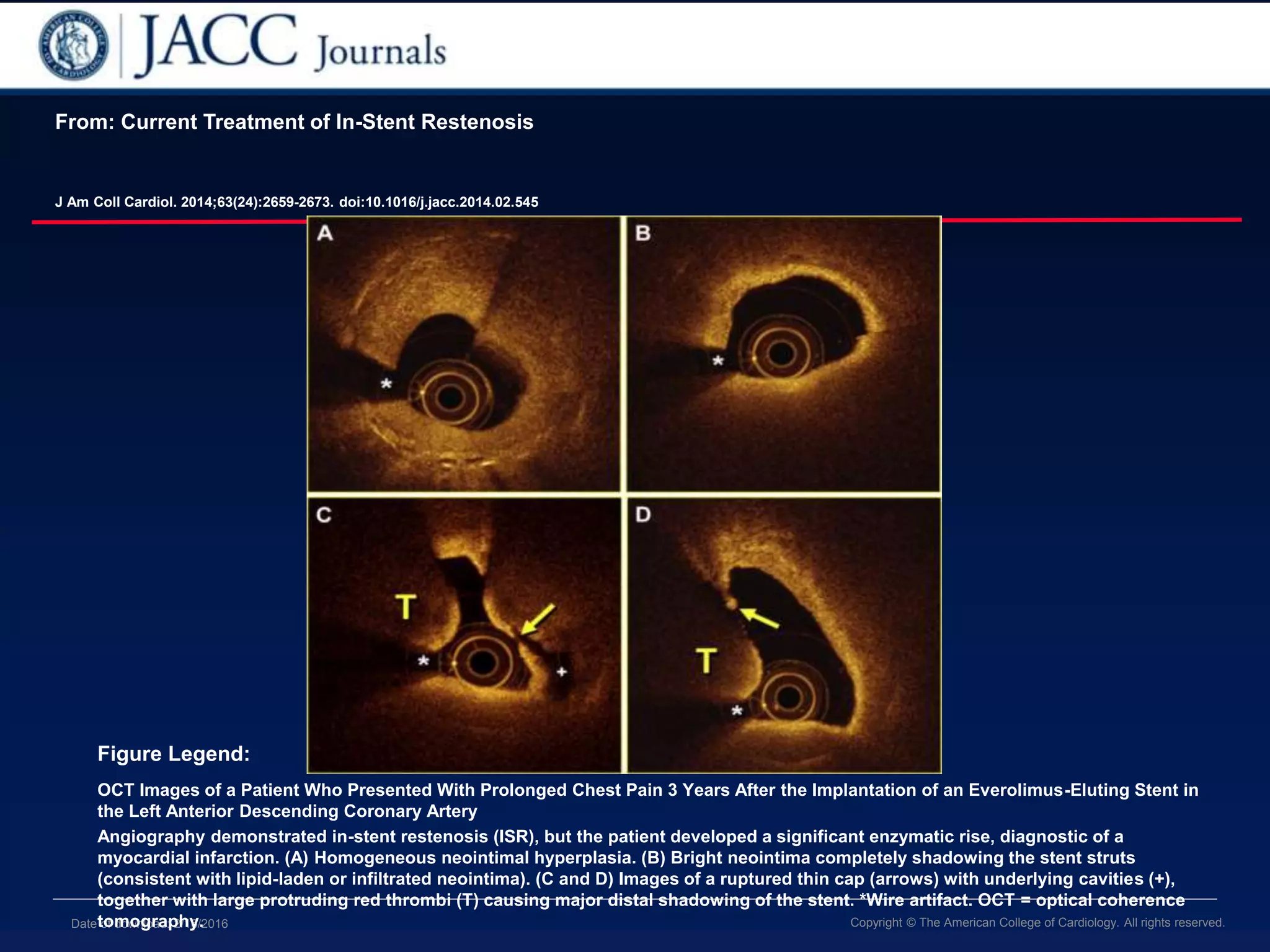 In stent re stenosis | PPTX