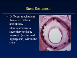 In stent re stenosis | PPTX