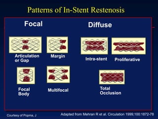 In stent re stenosis | PPTX