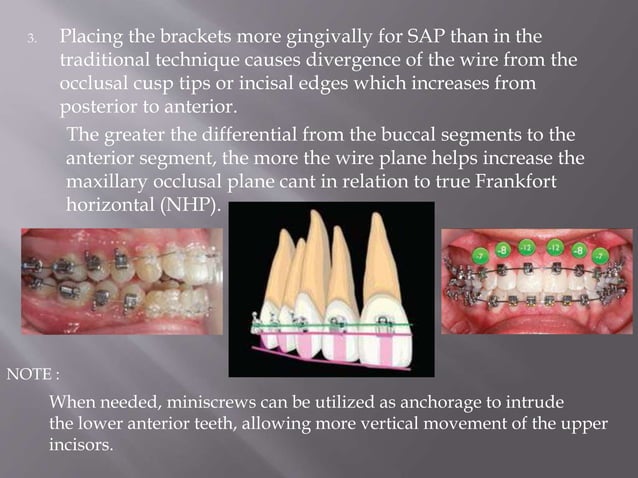 bracket positioning for smile arc protection | PPTX