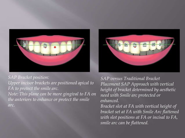 bracket positioning for smile arc protection | PPTX