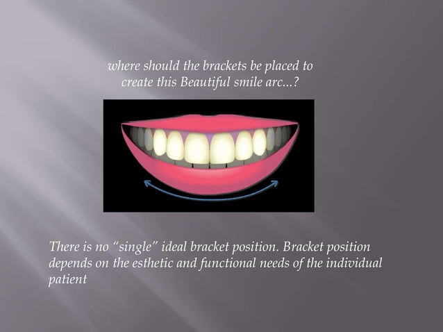 bracket positioning for smile arc protection | PPTX