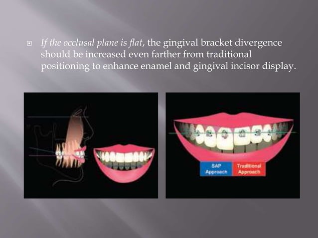 bracket positioning for smile arc protection | PPTX