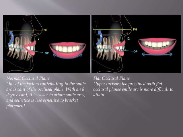 bracket positioning for smile arc protection | PPTX