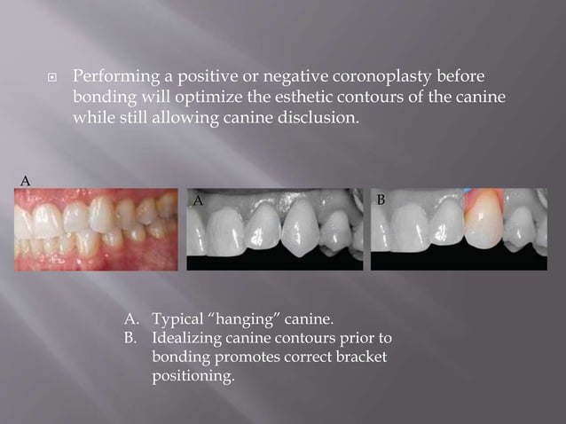 bracket positioning for smile arc protection | PPTX