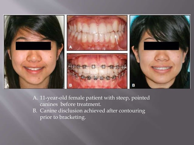 bracket positioning for smile arc protection | PPTX