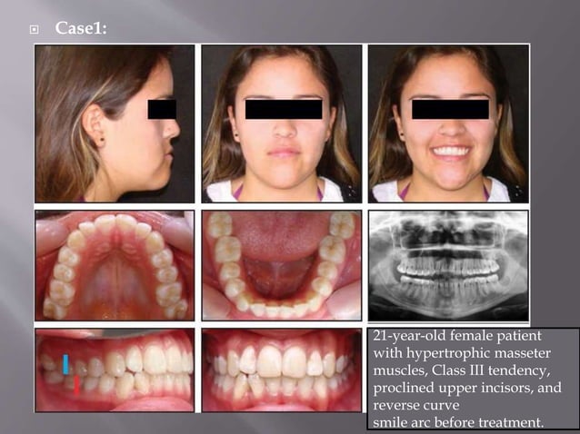 bracket positioning for smile arc protection | PPTX