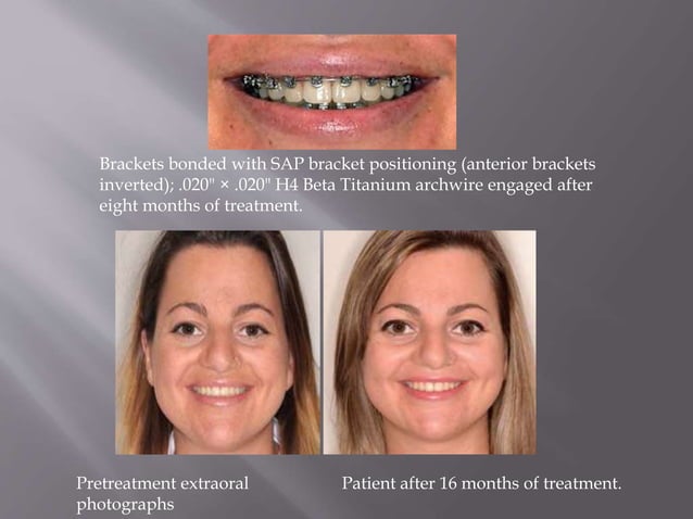 bracket positioning for smile arc protection | PPTX
