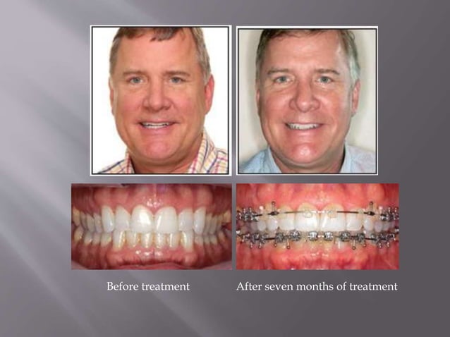 bracket positioning for smile arc protection | PPTX