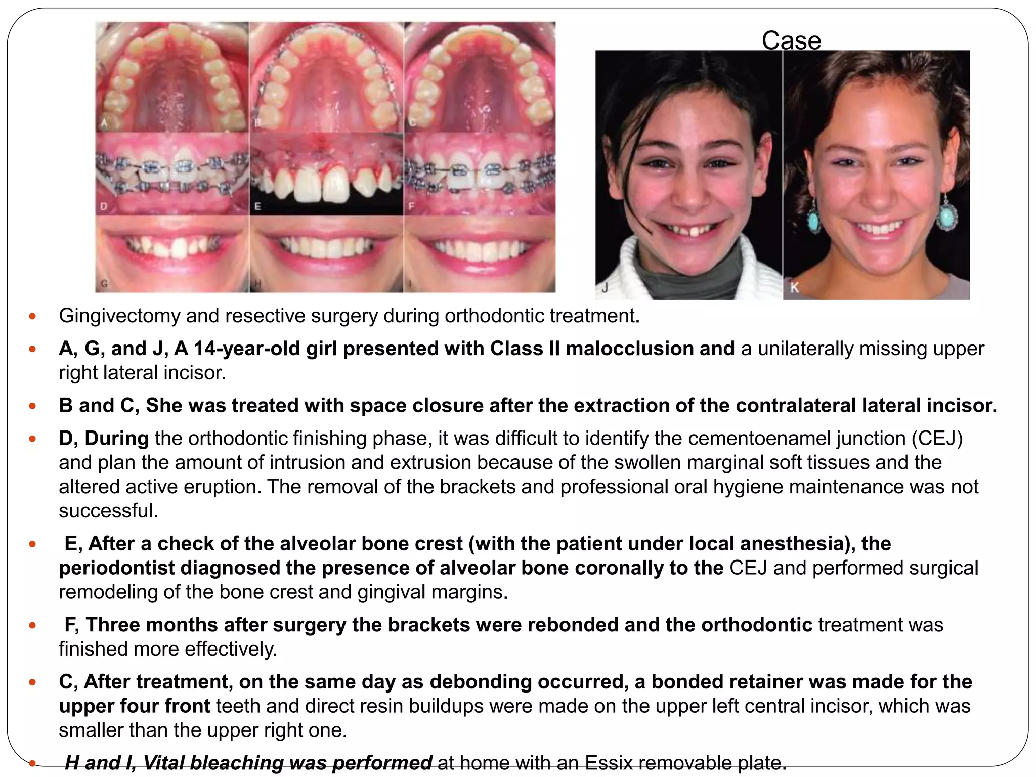 congenital missing maxillary lateral incisor(s) | PPTX
