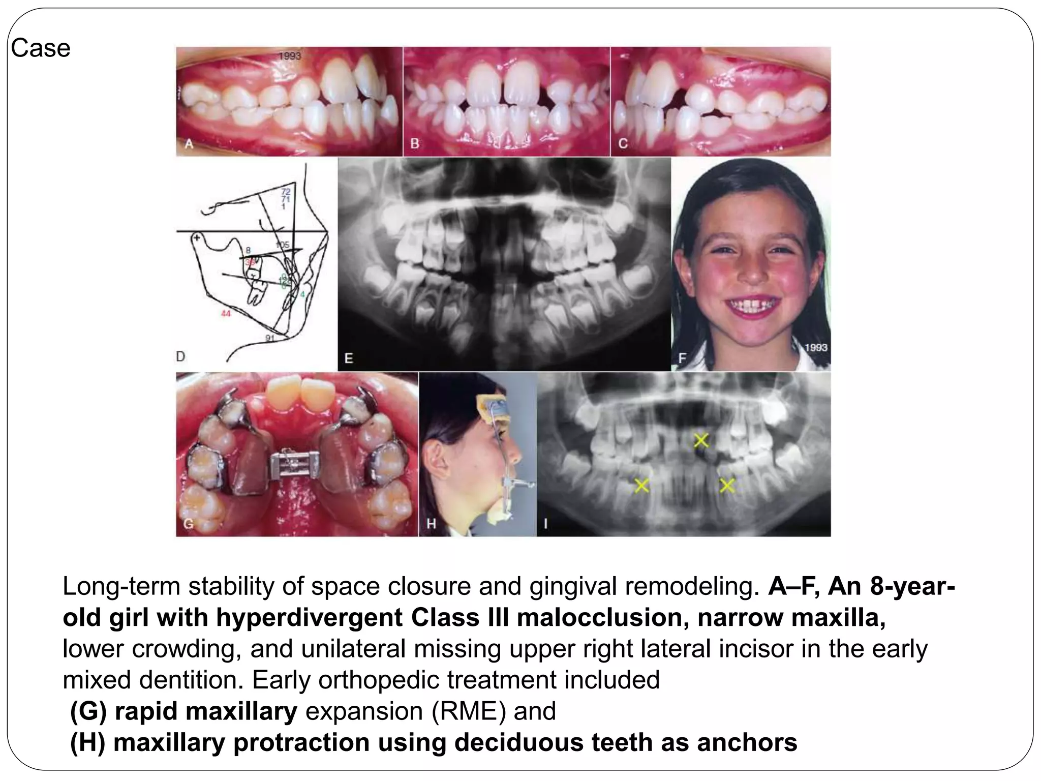 congenital missing maxillary lateral incisor(s) | PPTX