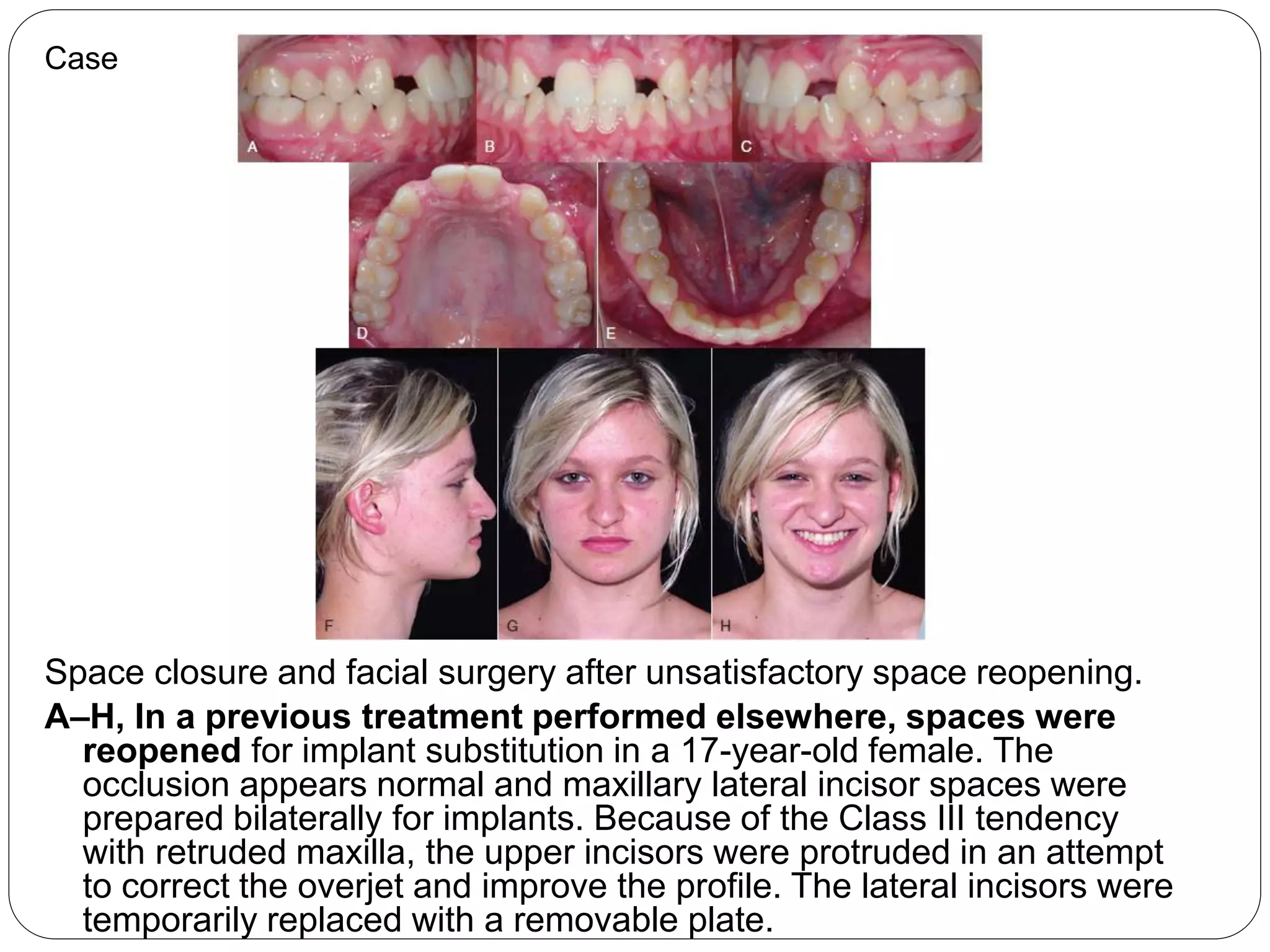 congenital missing maxillary lateral incisor(s) | PPTX