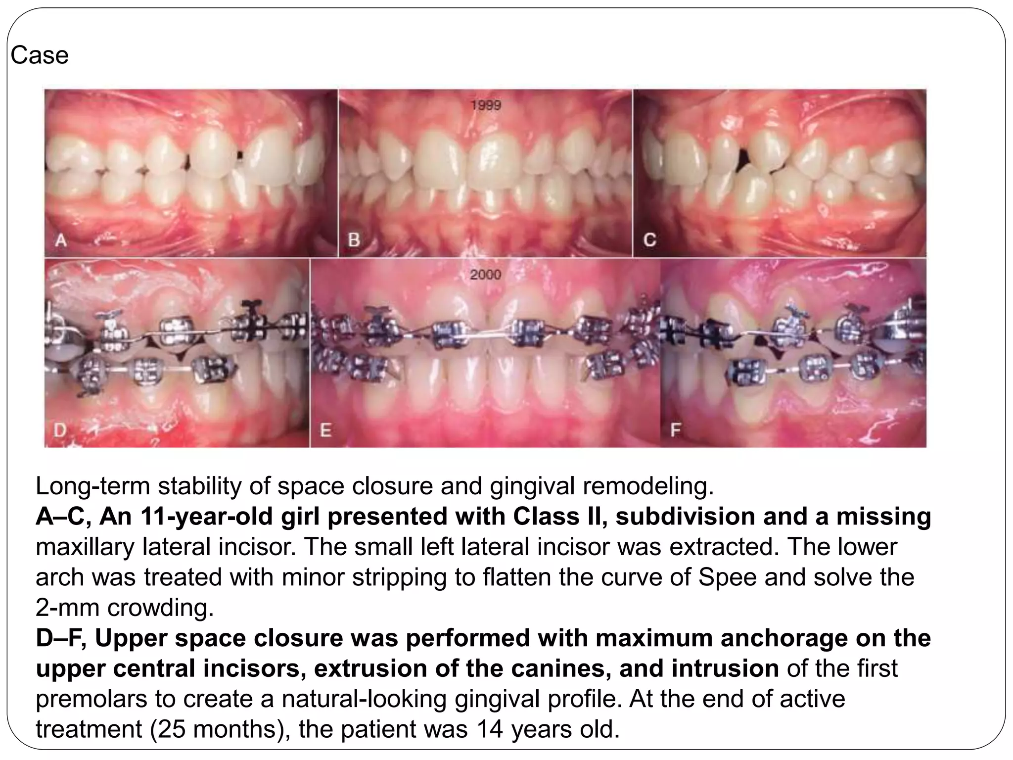 congenital missing maxillary lateral incisor(s) | PPTX