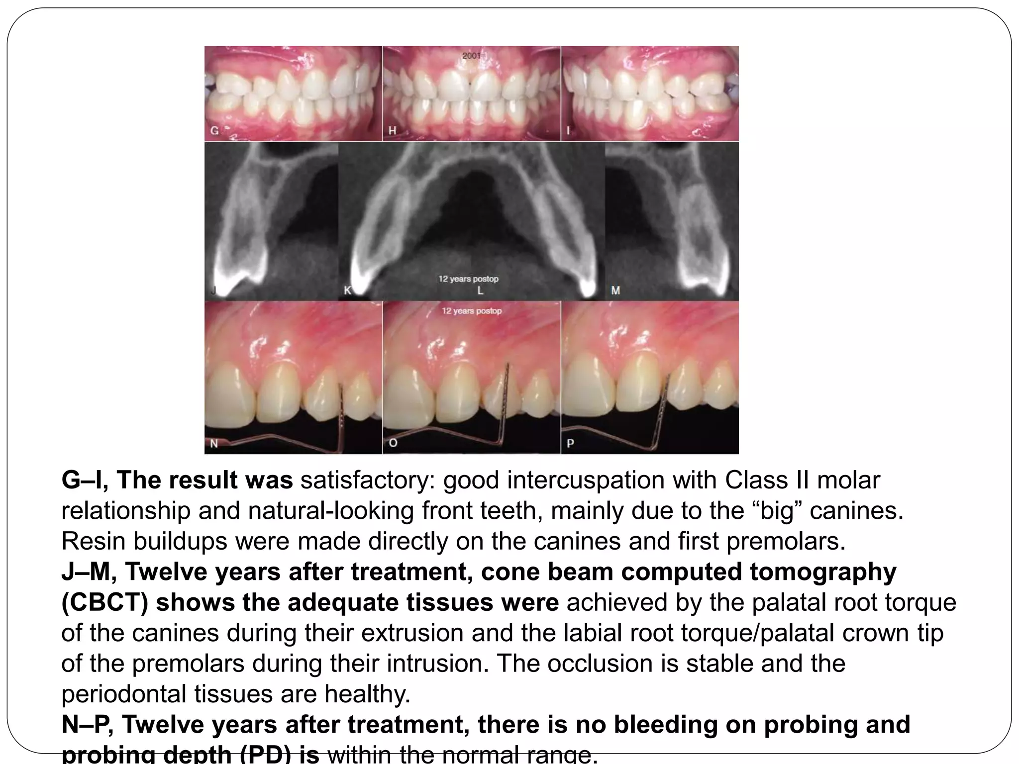 congenital missing maxillary lateral incisor(s) | PPTX