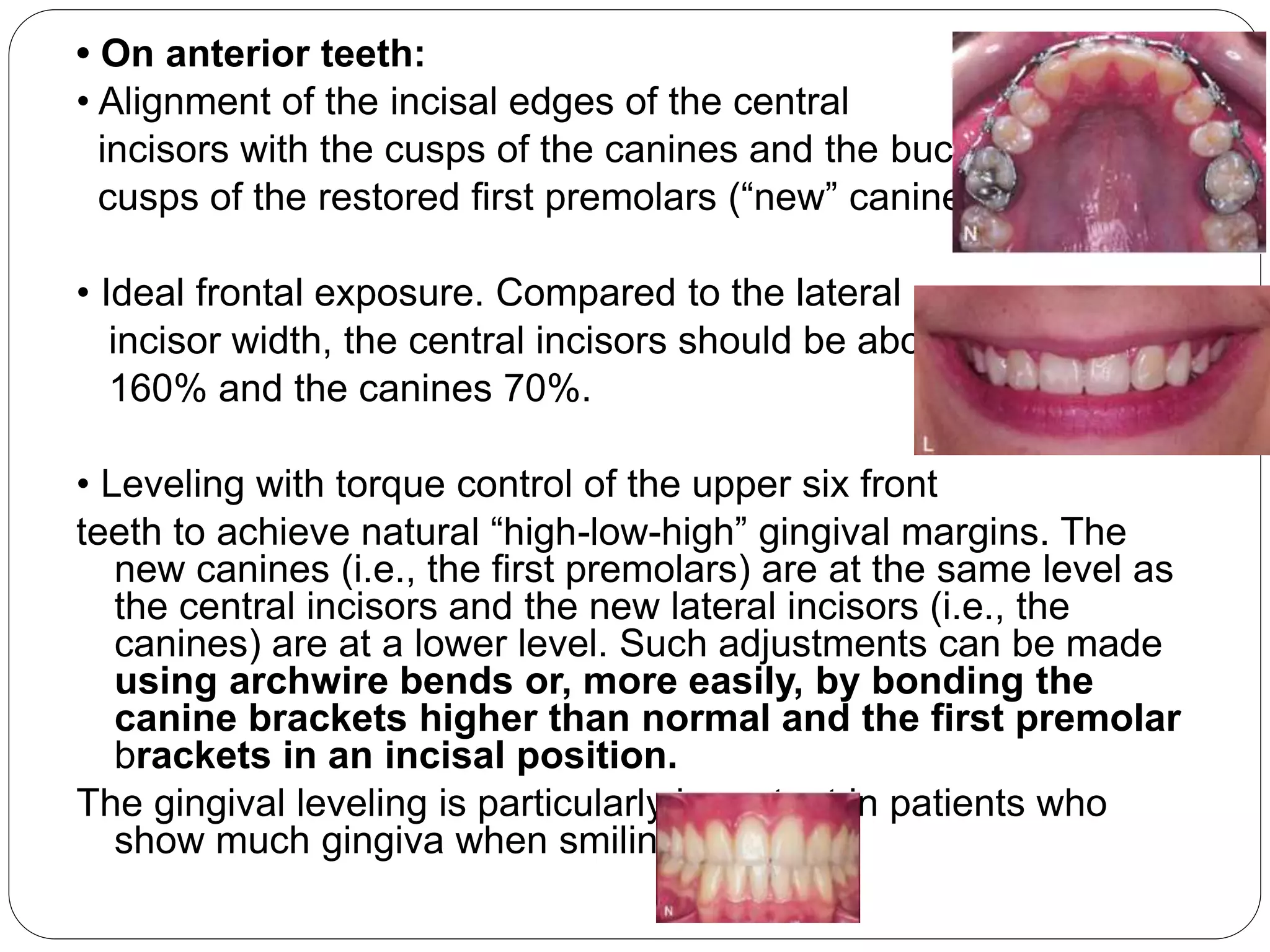 congenital missing maxillary lateral incisor(s) | PPTX