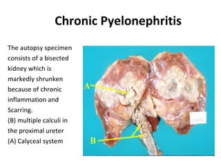 A Case of Acute Kidney Injury (ARF) | PPT