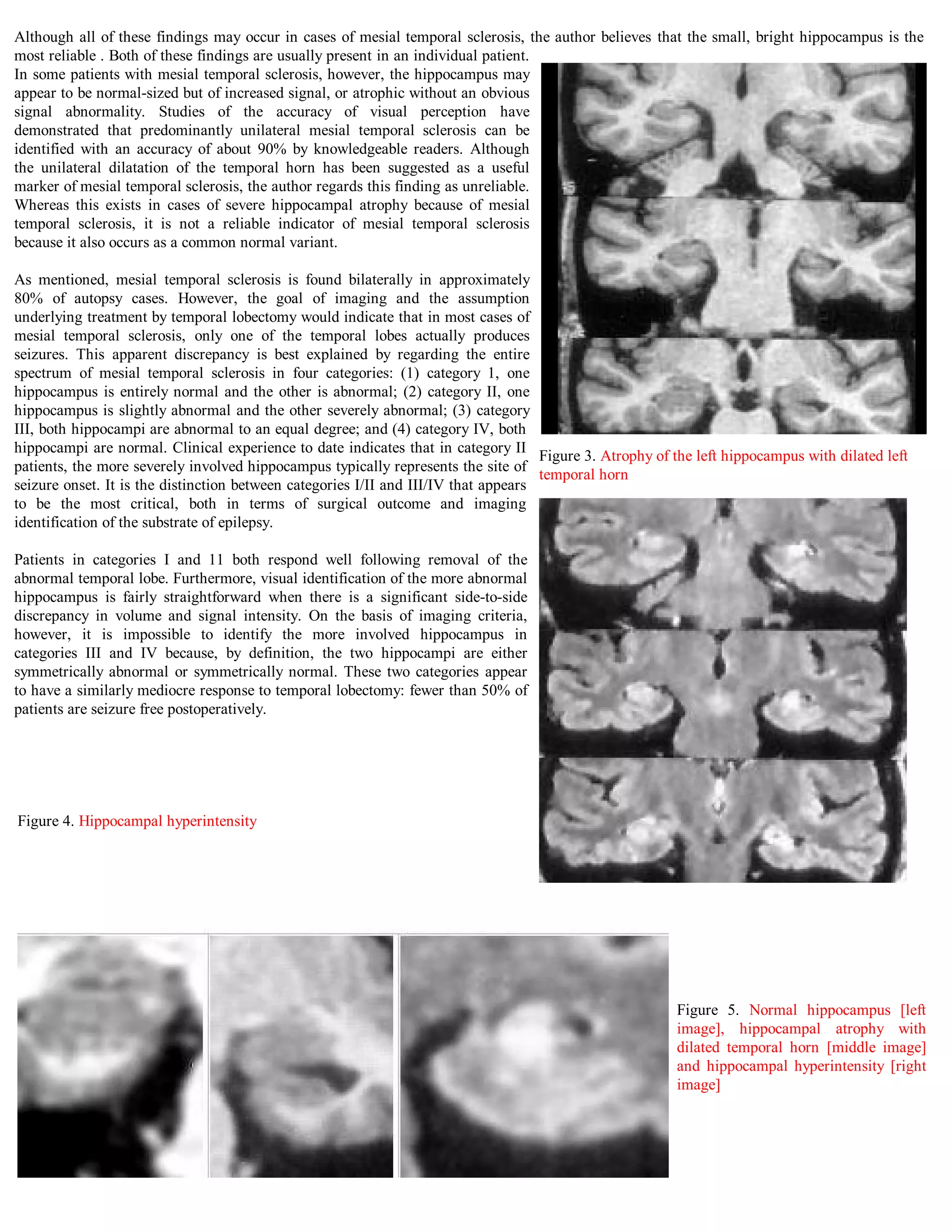 Issues in brainmapping...Temporal lobe epilepsy | PDF