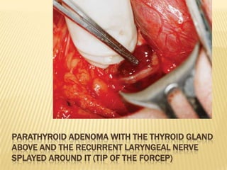 Issues in parathyroid surgery | PPTX