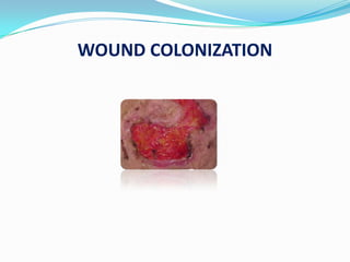 Infection of the chronic wound how to decide | PPTX