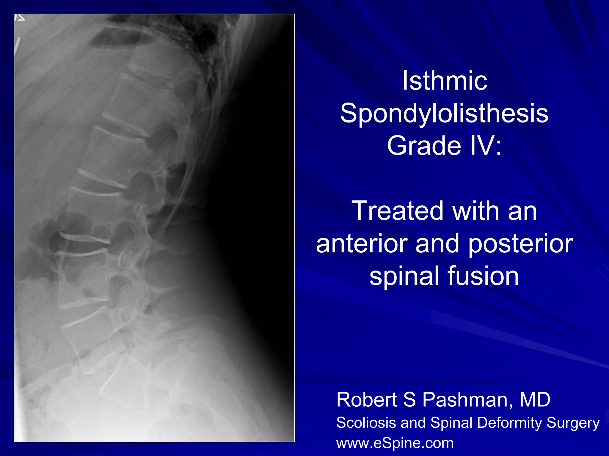 Case Review #1: 16 year old with Isthmic Spondylolisthesis Grade IV | PDF