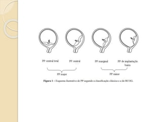 Deficiência Istmo-Cervical e Placenta Prévia | PPTX