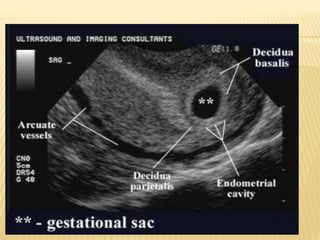 Ist trimester ultrasound | PPTX