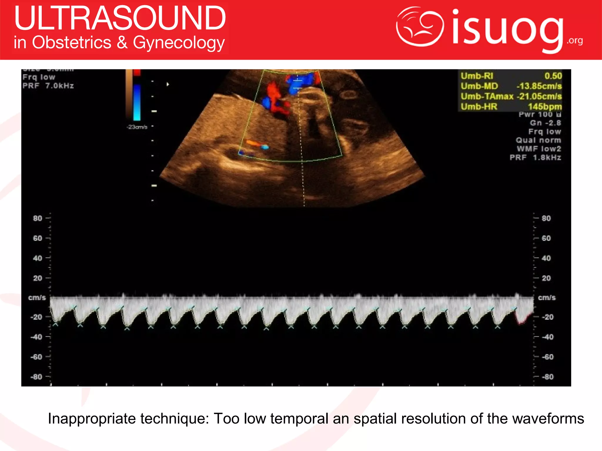 ISUOG Practice Guidelines: Use of Doppler ultrasonography in obstetrics ...