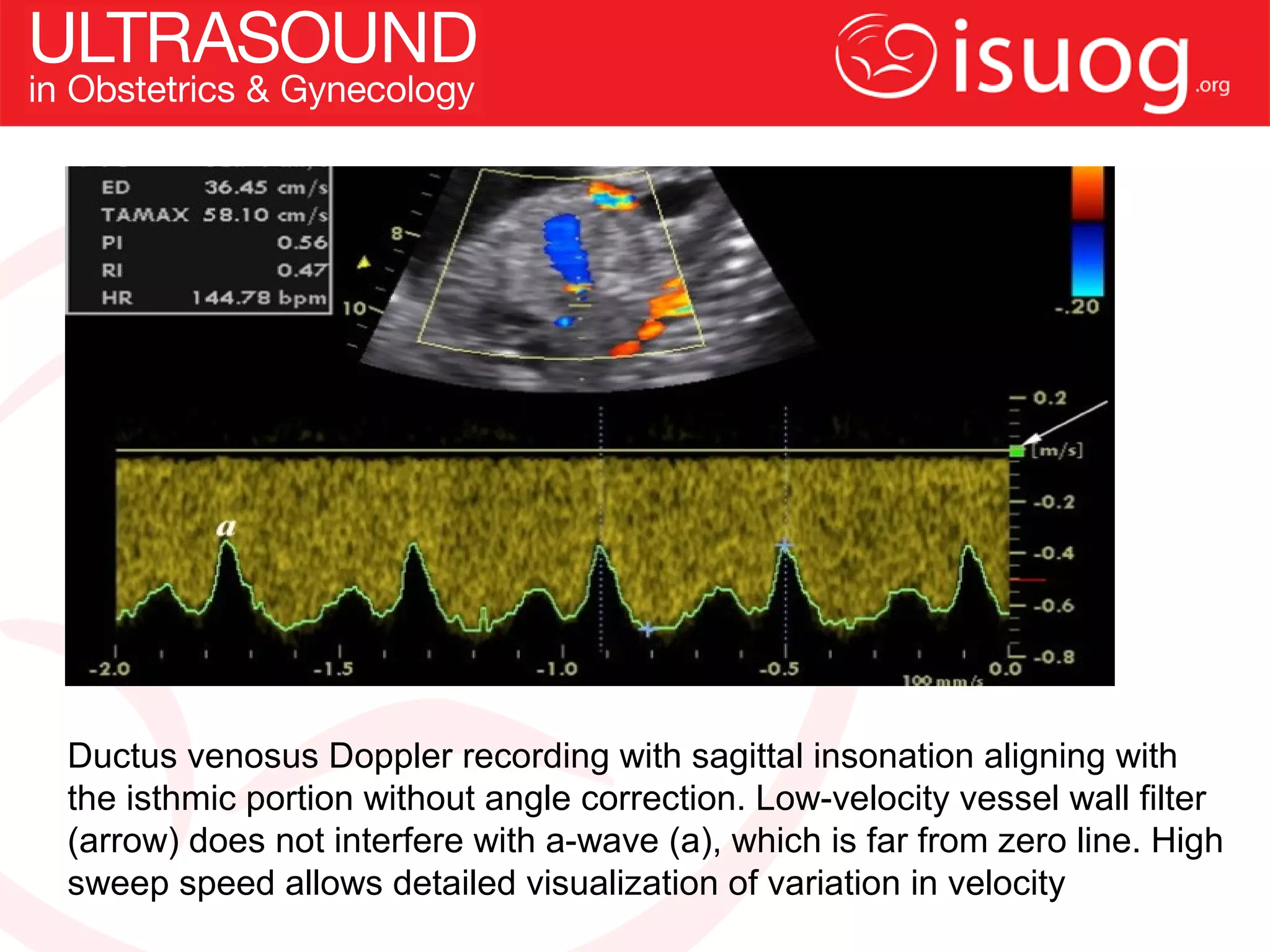 ISUOG Practice Guidelines: Use of Doppler ultrasonography in obstetrics ...