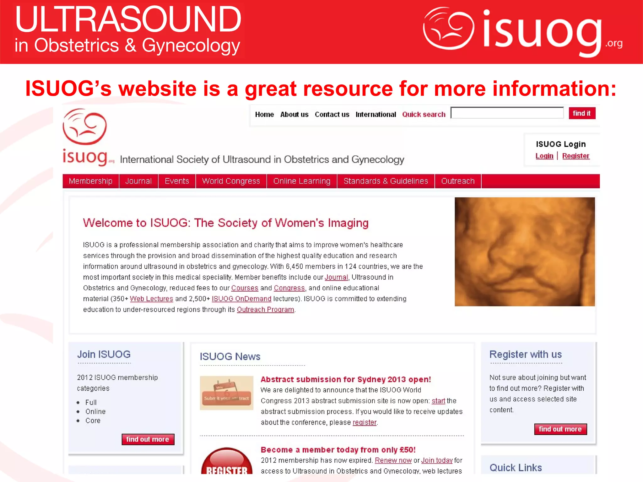 ISUOG Practice Guidelines: Use of Doppler ultrasonography in obstetrics ...
