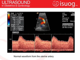 ISUOG Practice Guidelines: Use of Doppler ultrasonography in obstetrics ...