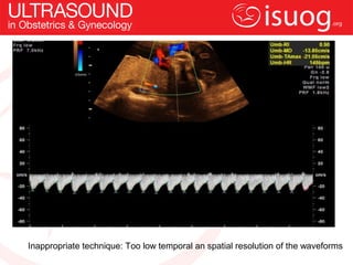 ISUOG Practice Guidelines: Use of Doppler ultrasonography in obstetrics ...
