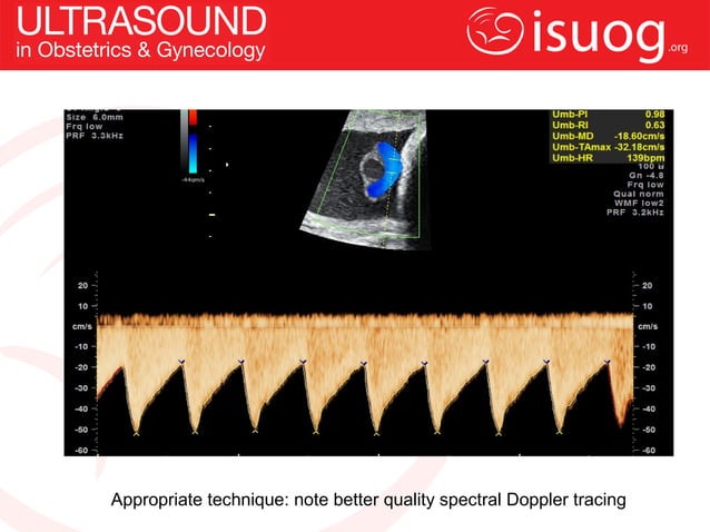 ISUOG Practice Guidelines: Use of Doppler ultrasonography in obstetrics ...