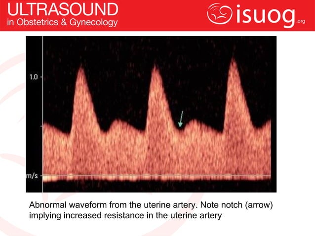 Isuog Practice Guidelines Use Of Doppler Ultrasonography In Obstetrics