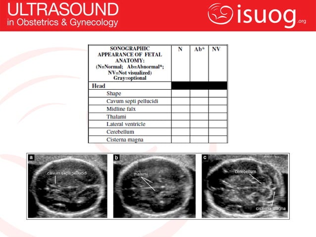 ISUOG Mid-trimester Guidelines | PPT