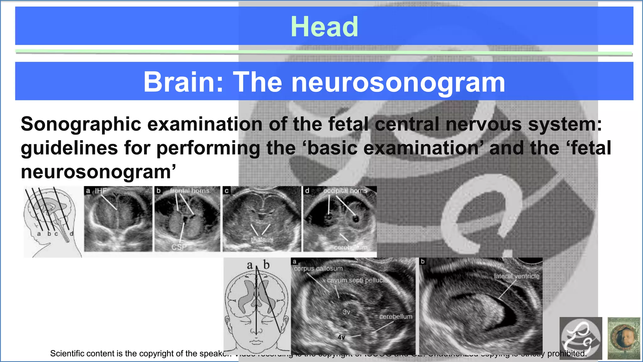 ISUOG 2nd trimester guidelines - Dr.Ashok Khurana | PPTX