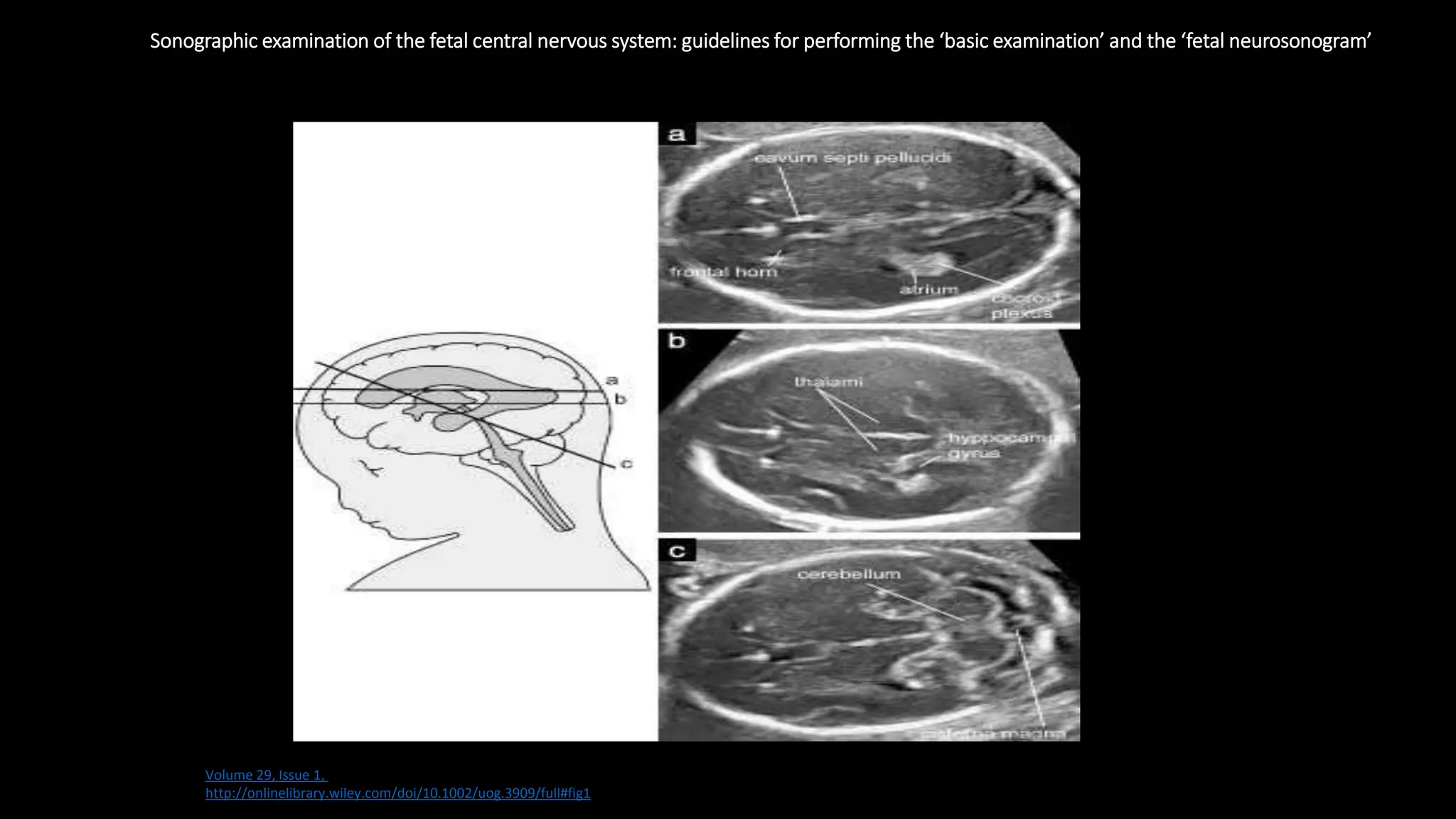 Isuog fetal cns usg guidelines | PPTX