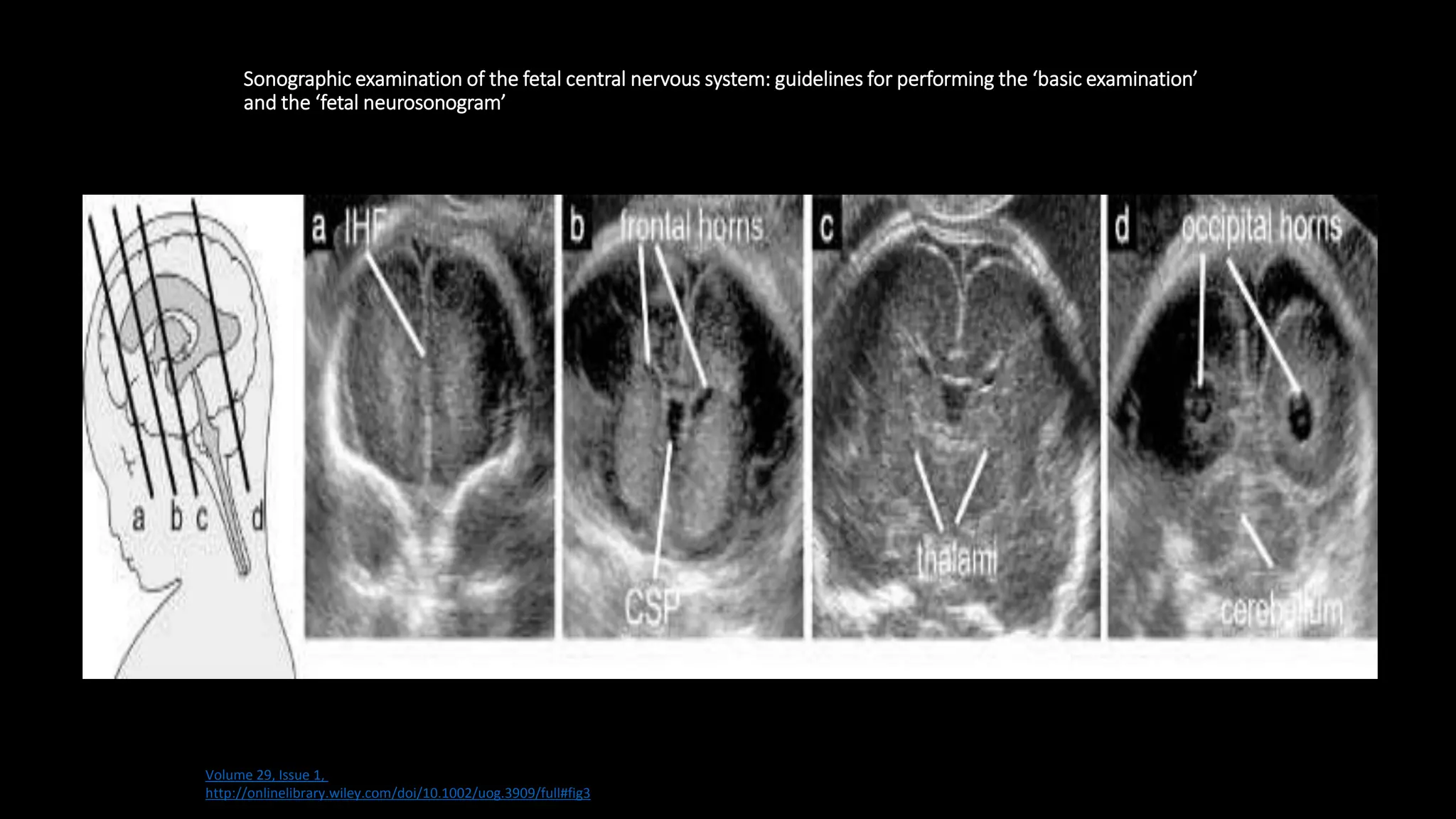 Isuog fetal cns usg guidelines | PPTX