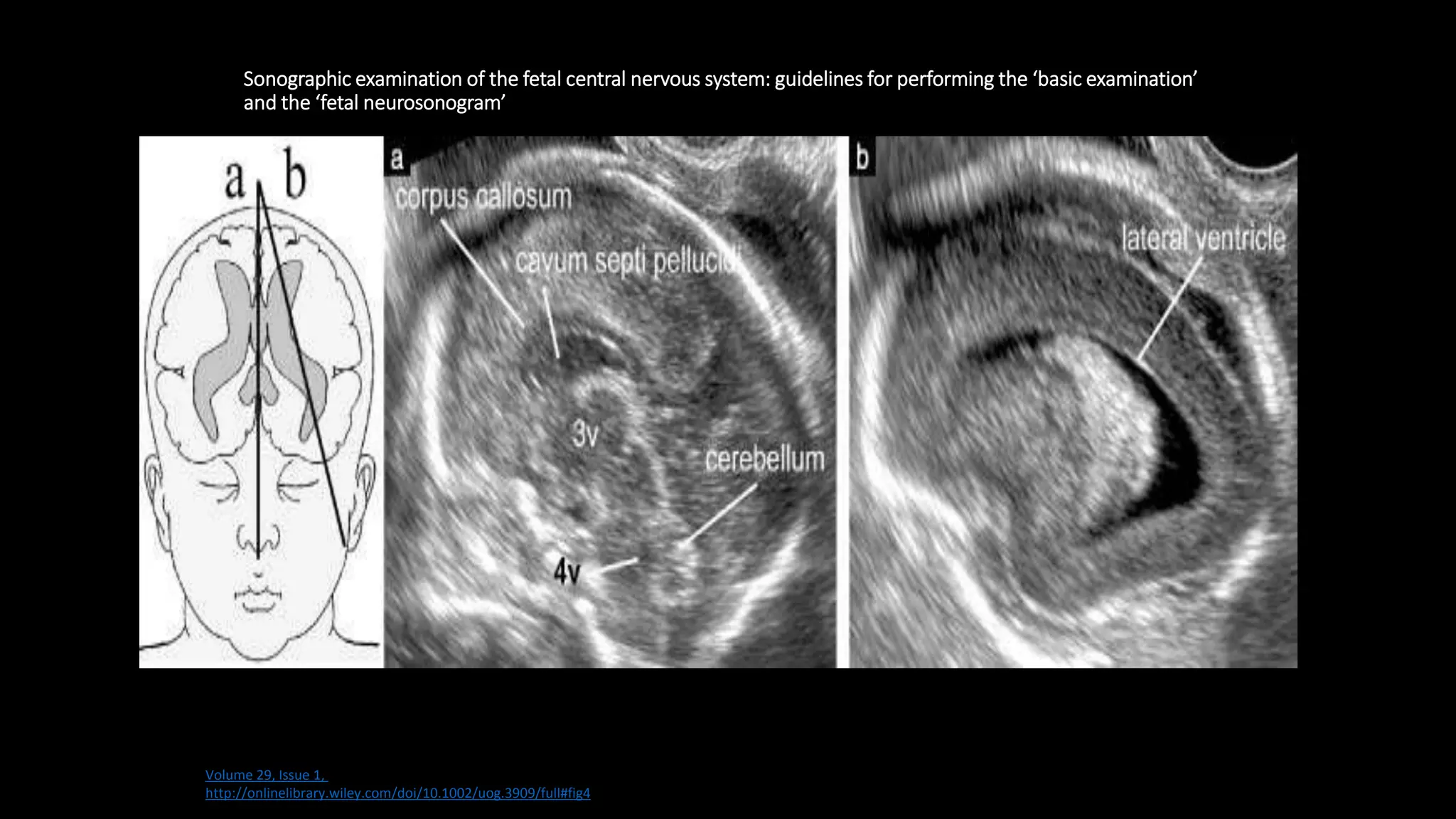 Isuog fetal cns usg guidelines | PPTX