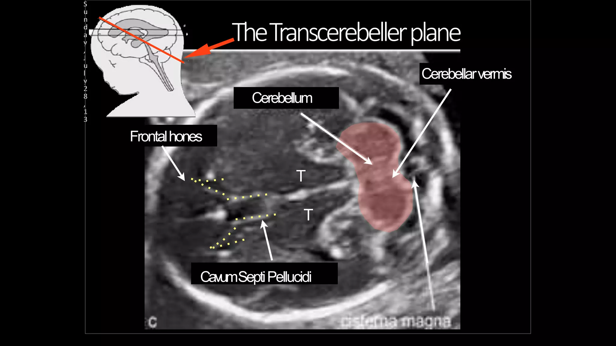 Isuog fetal cns usg guidelines | PPT