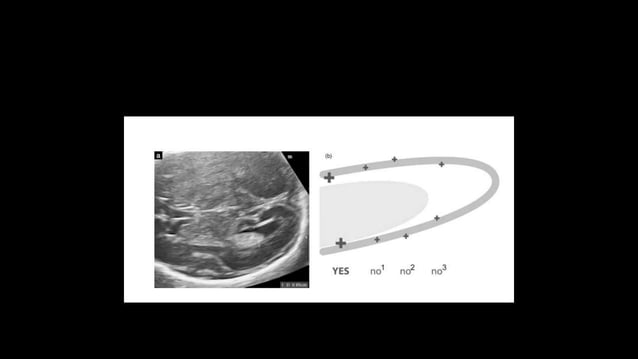 Isuog fetal cns usg guidelines | PPTX | Pregnancy | Reproductive Health