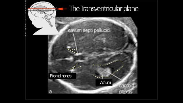 Isuog fetal cns usg guidelines | PPTX | Pregnancy | Reproductive Health