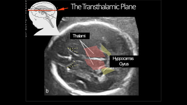 Isuog fetal cns usg guidelines | PPTX | Pregnancy | Reproductive Health