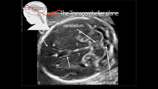 Isuog fetal cns usg guidelines | PPTX | Pregnancy | Reproductive Health