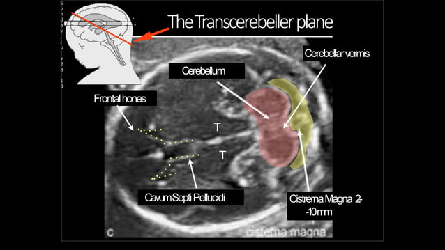 Isuog fetal cns usg guidelines | PPTX | Pregnancy | Reproductive Health