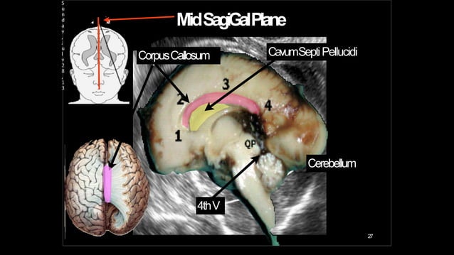 Isuog fetal cns usg guidelines | PPTX | Pregnancy | Reproductive Health