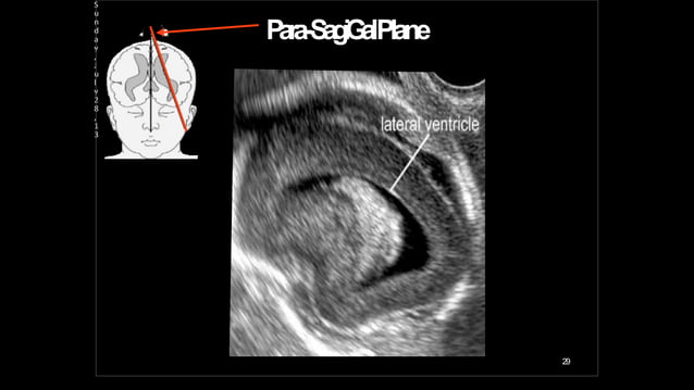 Isuog fetal cns usg guidelines | PPTX | Pregnancy | Reproductive Health