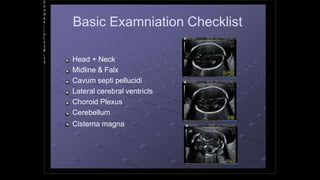 Isuog fetal cns usg guidelines | PPTX