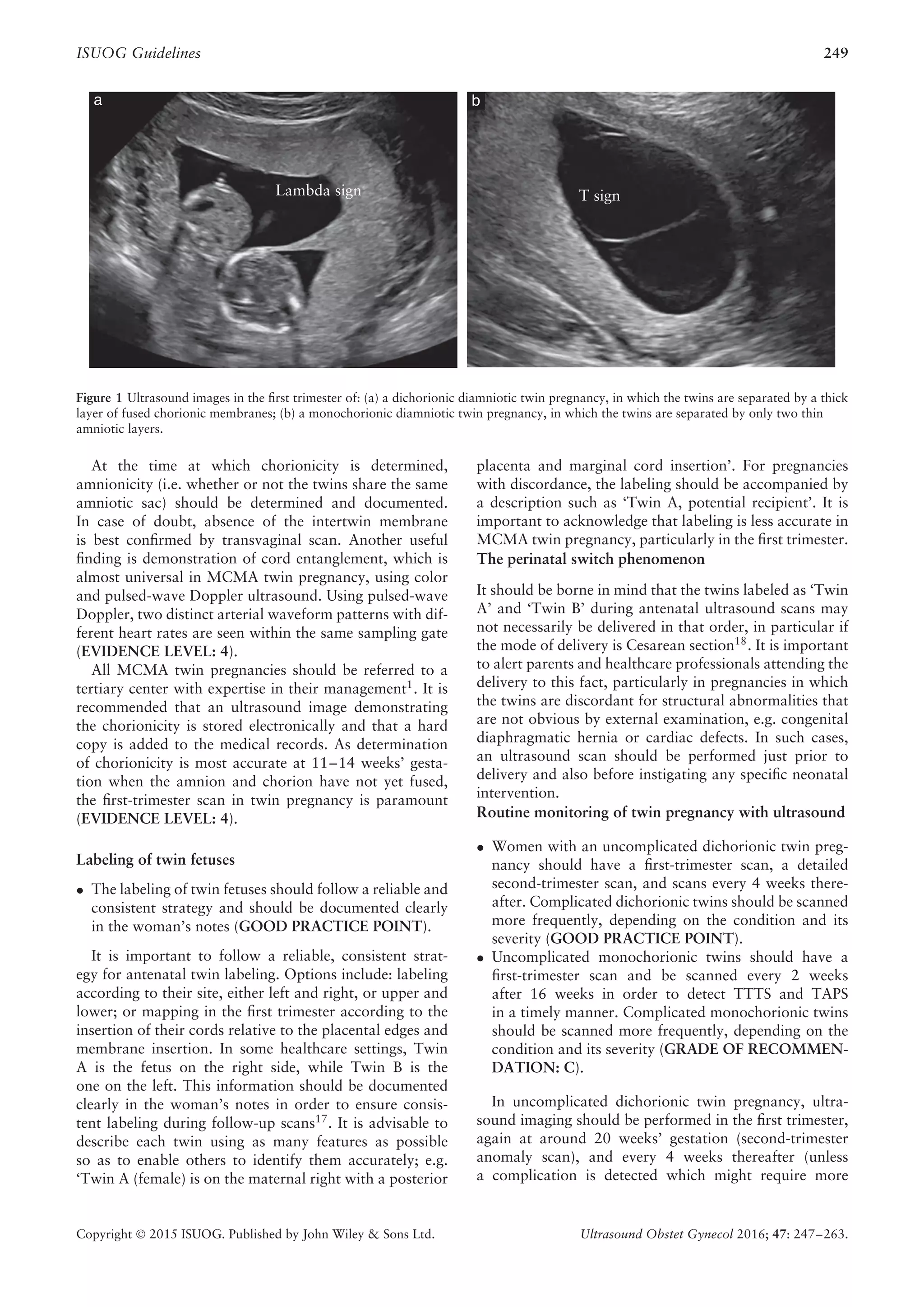 Guía ISUOG sobre ecografía en embarazo gemelar | PDF