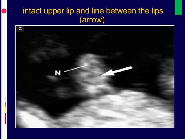 Isuog Practice Guidelines Performance Of First Trimester Fetal