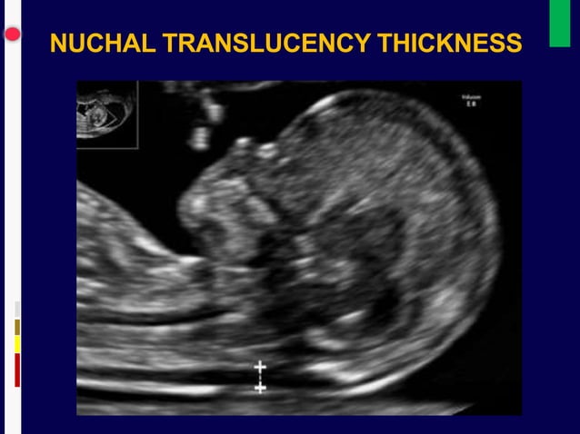 Isuog Practice Guidelines Performance Of First Trimester Fetal